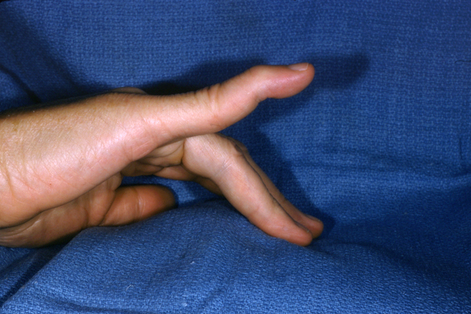 Swan Neck Deformity Hand Surgery Resource
